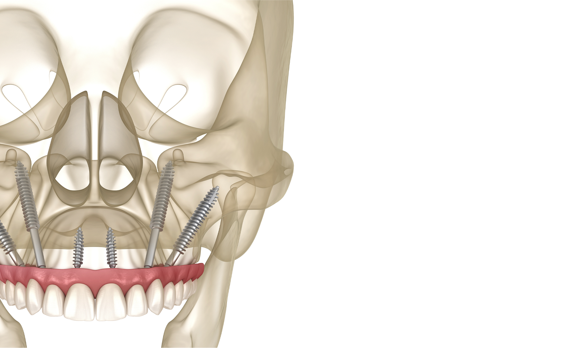 ADVANCED IMPLANTS - Dentzade